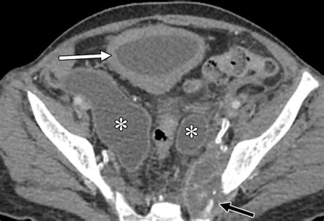Imaging Manifestations Of Genitourinary Tuberculosis Radiographics