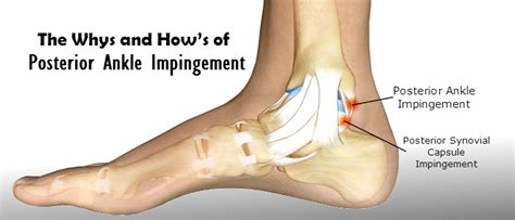 The Whys And Hows Of Posterior Ankle Impingement London Foot And Ankle Surgery Clinic