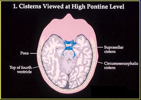 Image Result For Basal Cisterns Medical School Corpus