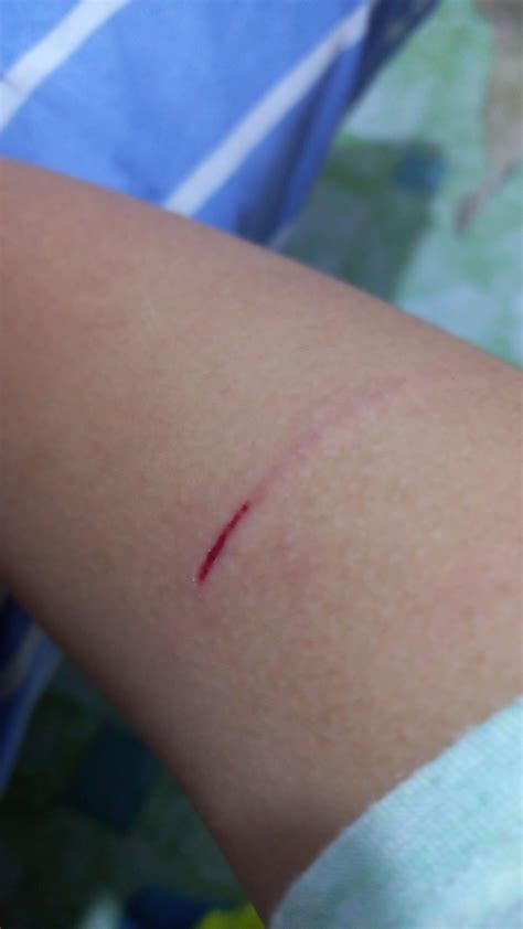 Am I Internally Bleeding R Whatshouldido