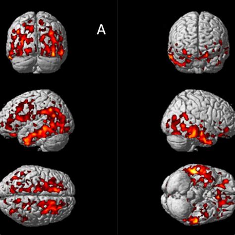 Hypothetical Framework Of Pathological Events Leading To Structural And Download Scientific