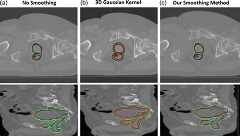 Effect Of Different Smoothing Filters On The Generated Contour