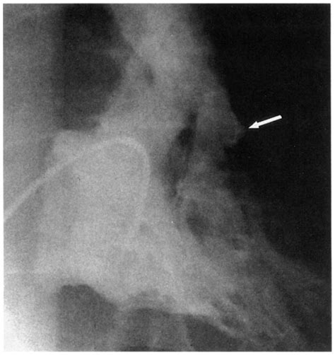 Right Ventricular Angiogram In The Right Anterior Oblique View During