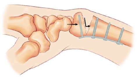 Schematic Diagram Showing Fi Xed Angle Implant Transferring Load Stress