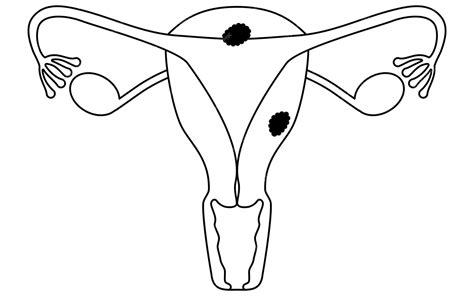 Premium Vector Illustrative Illustrations Of Endometrial Cancer