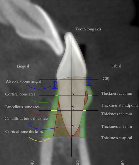 Cancellous Vs Cortical Bone