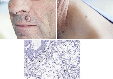 Disseminated Cryptococcosis NEJM