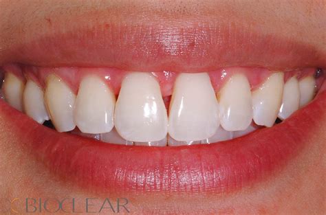 Black Triangles Between Teeth After Braces At Erin Patteson Blog