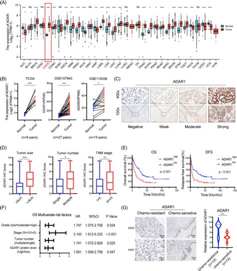 Adar1 Promotes Cisplatin Resistance In Intrahepatic Cholangiocarcinoma