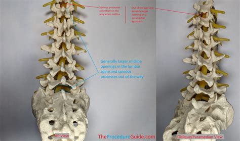 Lumbar Epidural Steroid Injection Levels At Keith Joseph Blog