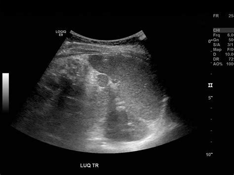 Accessory Spleen Splenule Splenunculus Sonographic Tendencies