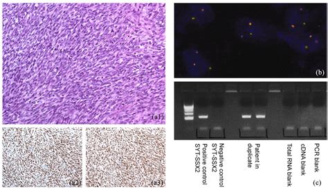 Validation Of A Ss18 Ssx2 Fusion Demonstrated By The Archerfusion Plex