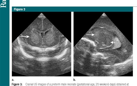 Figure 3 From Diffuse Hyperechogenicity Of Basal Ganglia And Thalami In