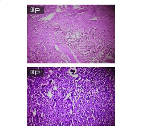 Microscopically Nesting Insular Pattern Of Growth Solid To Micro