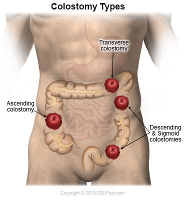 Types Of Colostomies Ostomy Care Nursing Small Intestine Vs Large