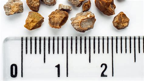 Виды камней в почках фото и описание плотность и способы лечения