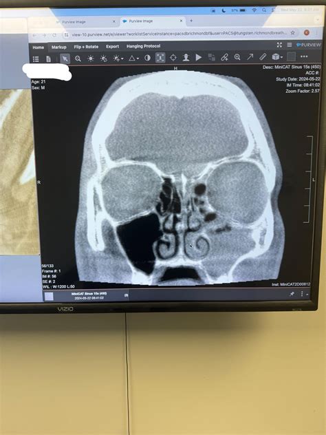 Sinus Surgery Questions R Sinusitis