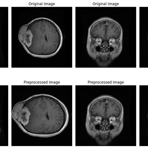 brain tumor mri classification dataset kaggle