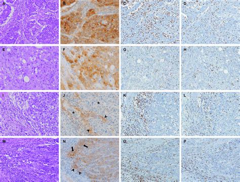 Immunohistochemical Ihc Staining Results For Pd L1 Cd3 And Cd8 And Download Scientific