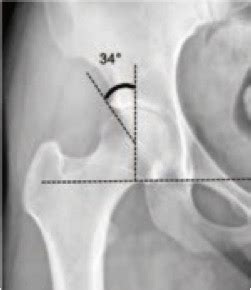 Femoroacetabular Impingement Fai Knee And Sports Orthobullets