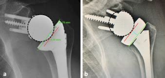 Onlay Versus Inlay Reverse Total Shoulder Arthroplasty A Retrospective
