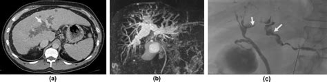 Radiological Findings In Ischaemic Cholangiopathy Clinical Radiology Radiological Findings In Ischaemic Cholangiopathy Clinical Radiology