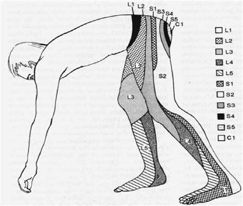 A Review Of Lumbar Radiculopathy Diagnosis And Treatment Pmc