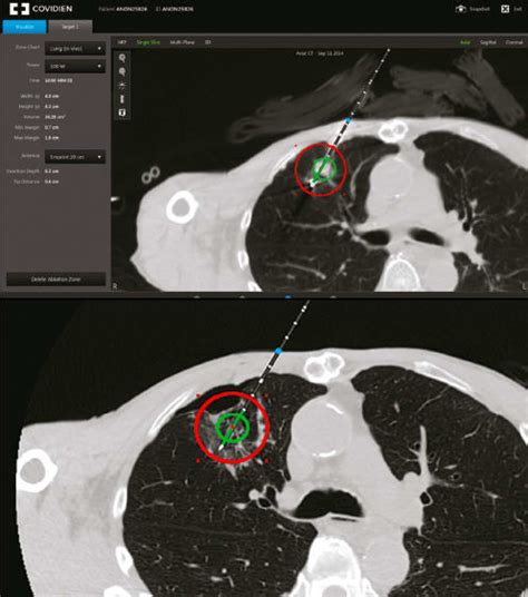 Advancing Ablation Technology Using Simulation Science Medical Design