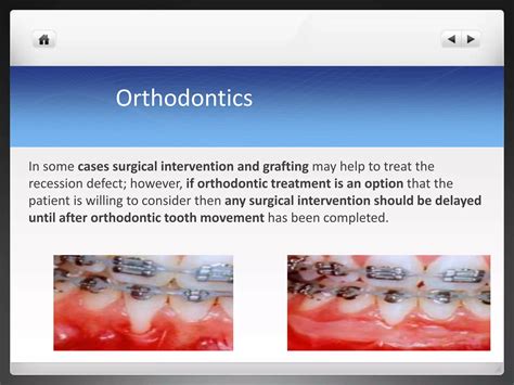 Root Coverage Procedures Pptx