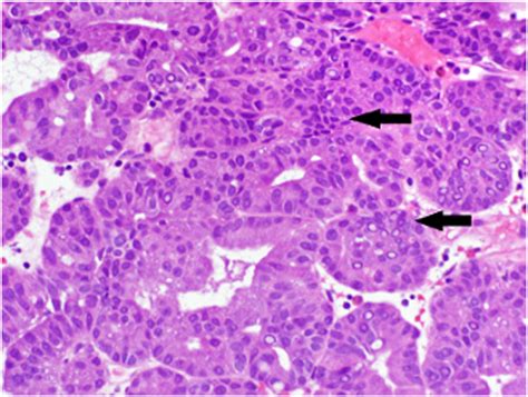 High Grade Dysplasia Ipmn 悪性度 Baobz