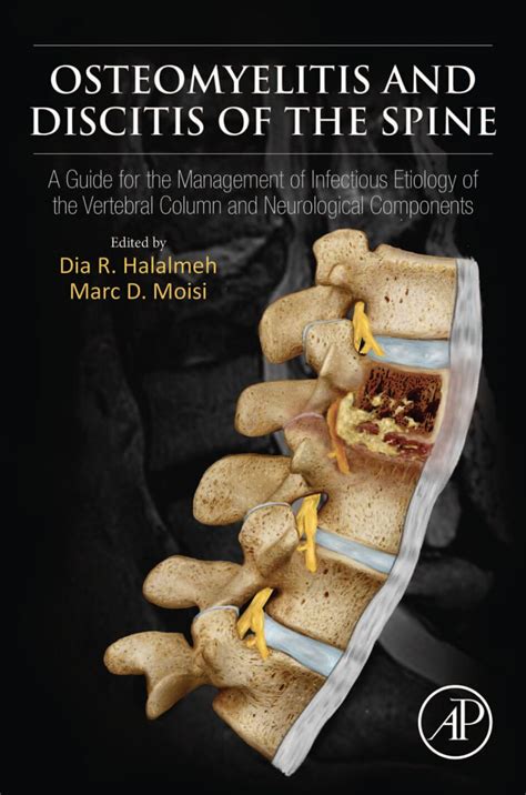 Excited To Share That The Book Osteomyelitis And Discitis Of The Spine Featuring Our Chapter