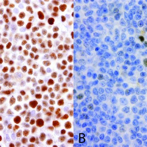 MYC IHC In Two Diffuse Large B Cell Lymphomas DLBCL A DLBCL Case Download Scientific
