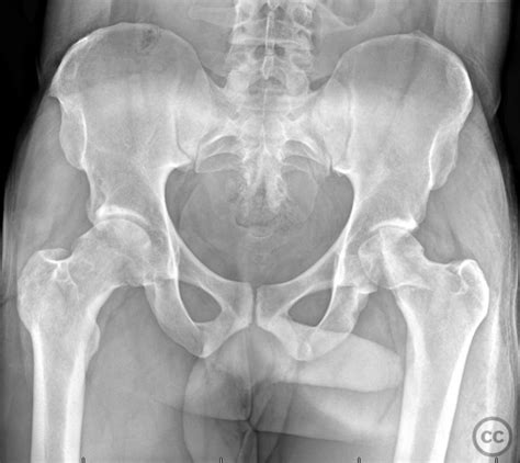 Femoral Head Fracture Pipkin Ii Treated With Surgical Dislocation