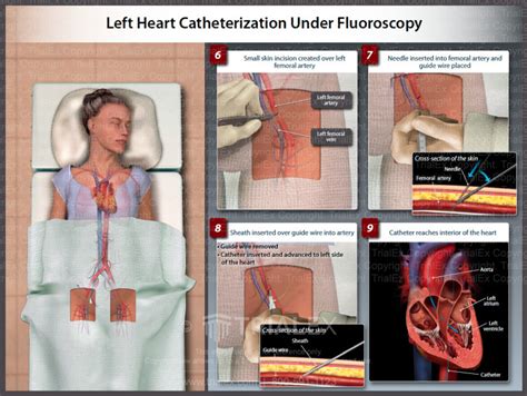 Left Heart Catheterization Under Fluoroscopy Trialquest Inc