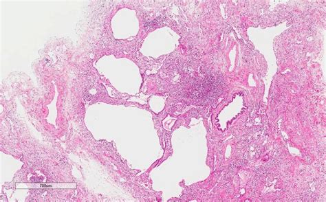 Interstitial Lung Disease Histology Interstitial Lung Diseases