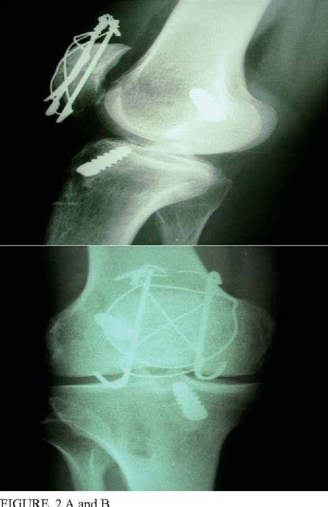 Figure 2 From Disruption Of The Knee Extensor Apparatus Complicating