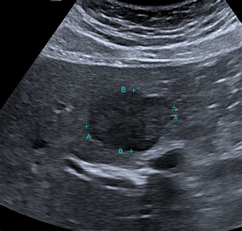 Focal Nodular Hyperplasia
