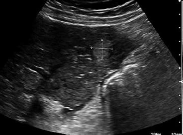 Hyperechoic Hepatocellular Carcinoma As Pect In Standard Us