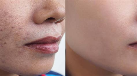 Understanding Hyperpigmentation Acne Scars Causes And Solutions How