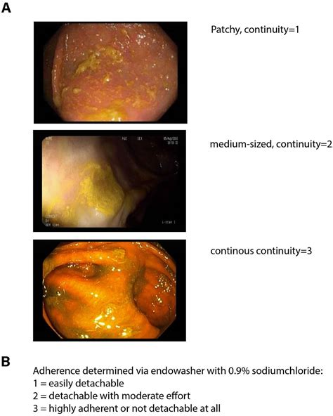 Gastrointestinal Biofilms Endoscopic Detection Disease Relevance And