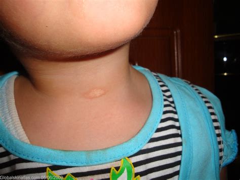 Global Skin Atlas Diagnosis Detail