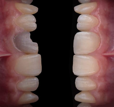 Managment Of Traumatic Tooth Step By Step Myzerodonto