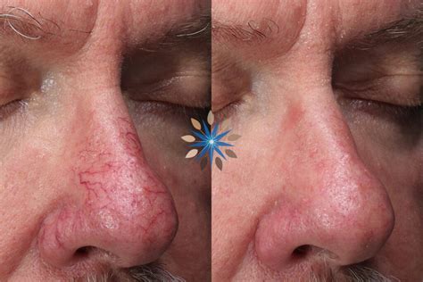 Telangiectasia Face Lasers For Telangiectasias Ny Facial