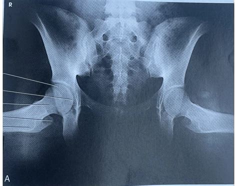 Axiolateral Projection Original Cleaves Method Quiz