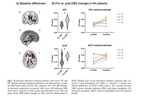 Onlinefirst Neurosurgery Actaneuro Dbs Acta Neurochirurgica The European Journal Of