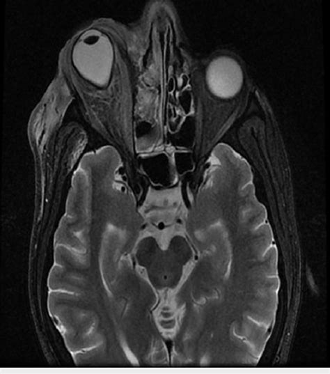 Mri T2 Brain Axial View The Image Shows Right Orbital Cellulitis And Download Scientific