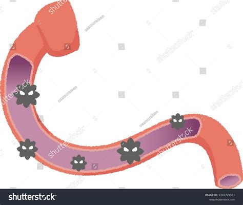 Duodenitis Condition Which Mucous Membrane Duodenum Stock Vector