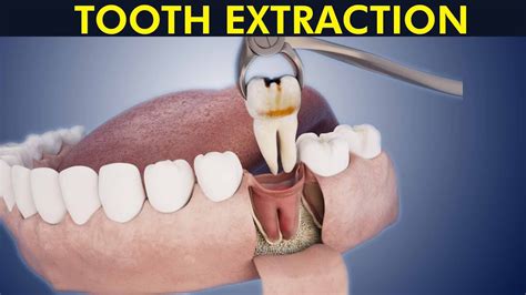 The Tooth Extraction Process Step By Step Youtube