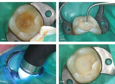 Direct Pulp Capping Technique At Dorothy Choi Blog