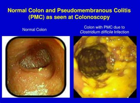 Pseudomembranous Colitis Medizzy